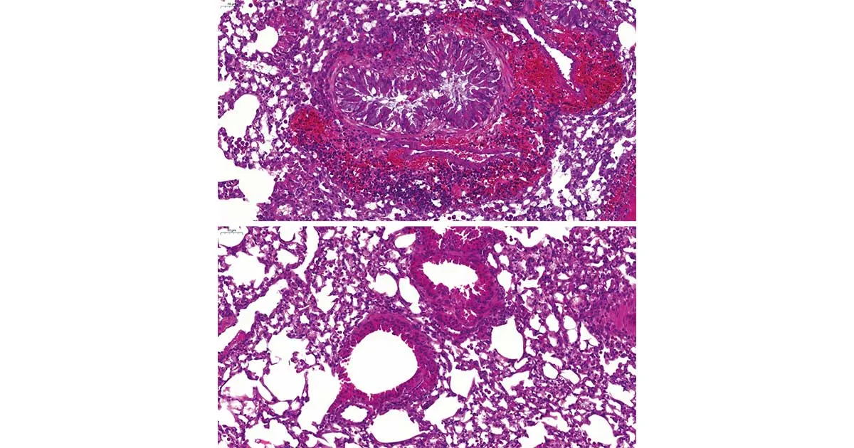Asthme allergique : sur la piste d'un vaccin | Fondation pour la ...
