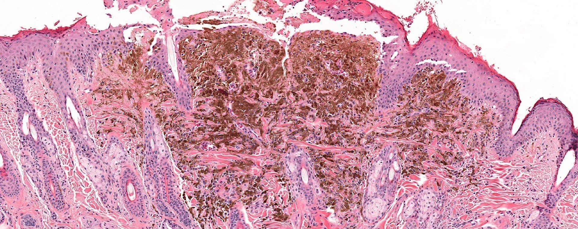 Cancer De La Peau Explorer Les Mécanismes De Développement Des