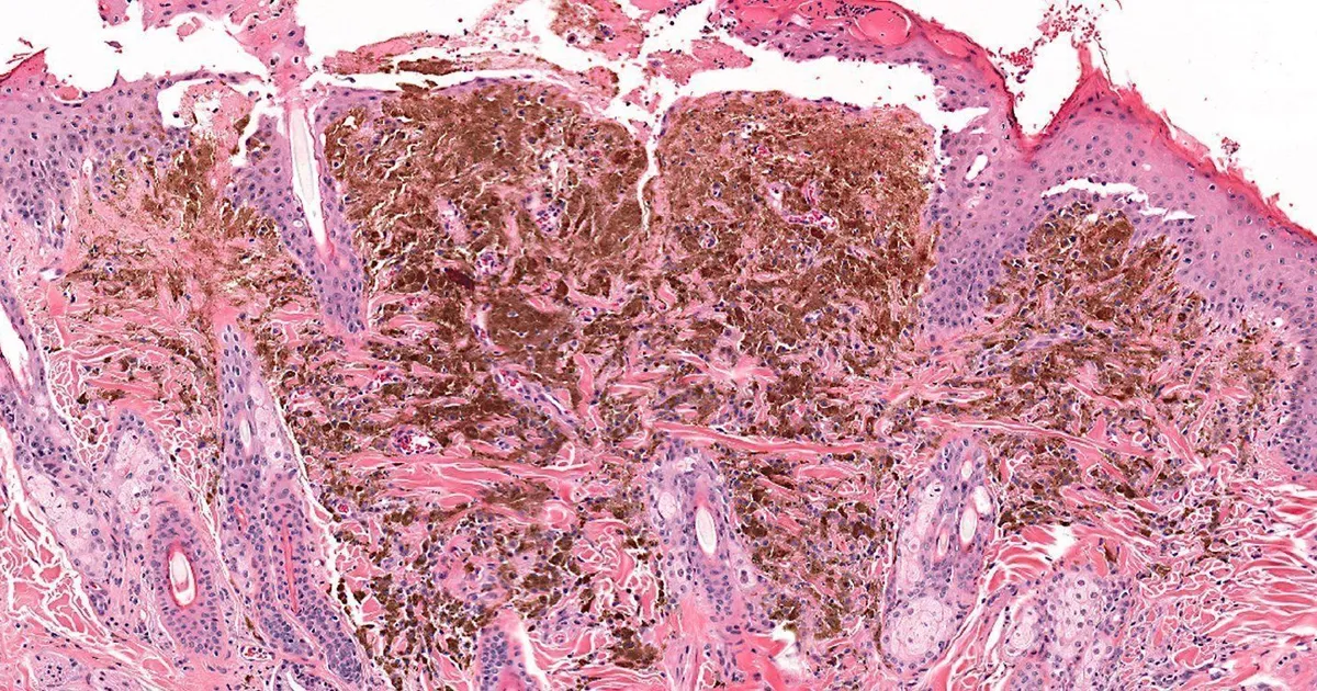 Cancer De La Peau Explorer Les Mécanismes De Développement Des