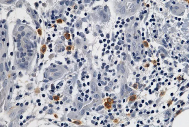 Cancer du sein : le système immunitaire à l'assaut des cellules ...