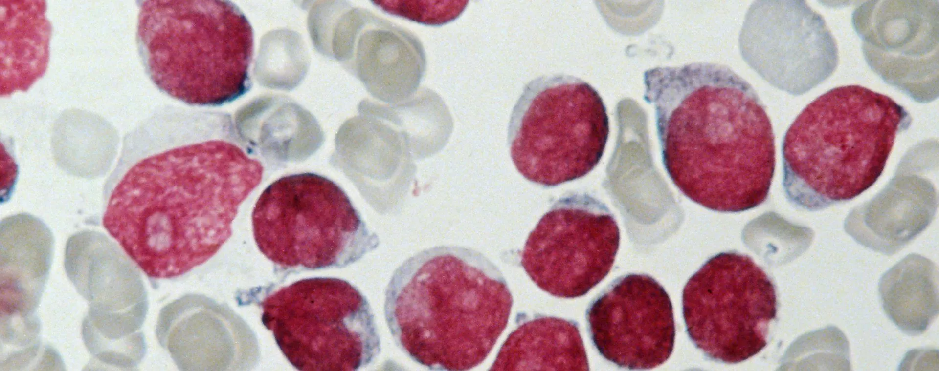 Leucémies aiguës myéloïdes : développer un nouveau traitement contre ...