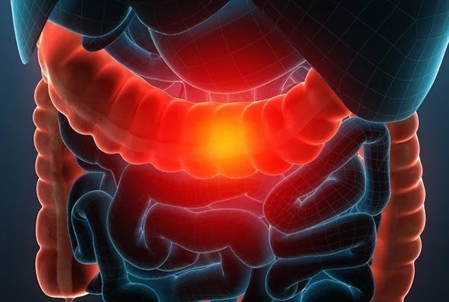 Caractériser les cellules immunitaires responsables de la rectocolite ...