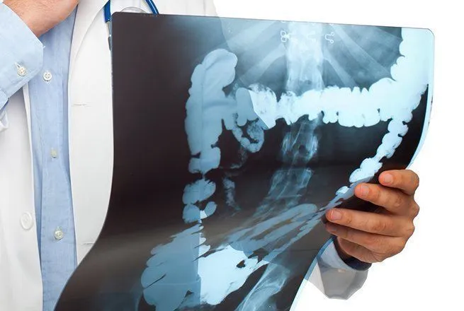 Quelle est l’implication de la flore bactérienne dans les MICI ...